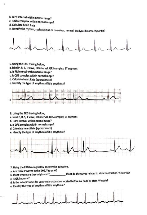 Solved Question 1 Determine The QRS Axis For This ECG A Chegg