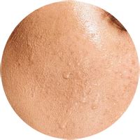 Rough Skin On Face Causes Treatments And Prevention Tips The Pink