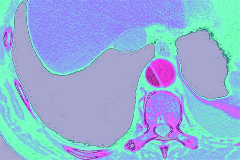 Aortic Dissection Or Dissecting Aneurysm Photograph By James Cavallini Fine Art America