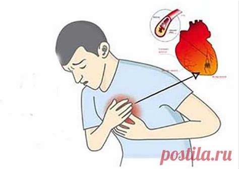 Предупреждающие признаки сердечного приступа которые вы не должны и Cook Постила