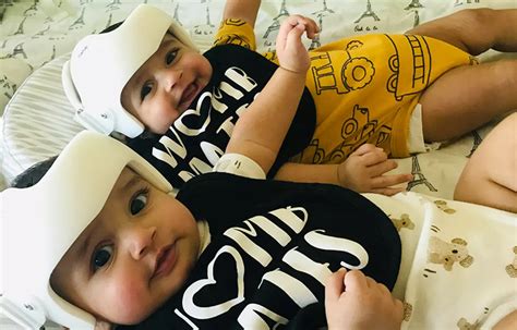 Doc Band® Treatment For Plagiocephaly Cranial Technologies