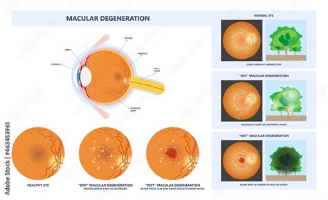 Macular Degeneration Hemorrhage Dry Wet Age Hole Pucker Edema Eye