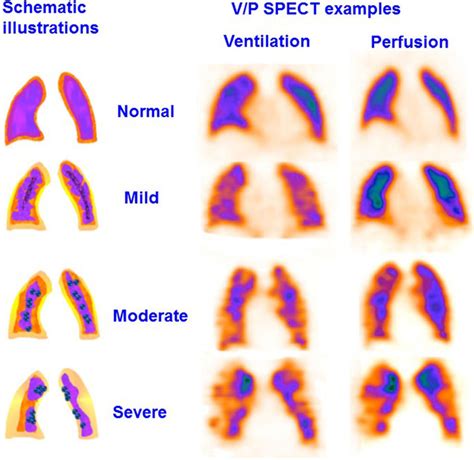 Schematic Presentation Of The Obstructive Lung Disease Grading System