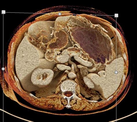 Pancreatic Cancer With Dilated Pancreatic Duct And Incidental Gist Tumor Stomach Pancreas
