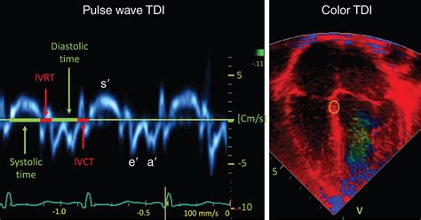 Advanced Cardiac Imaging In The Newborn Tissue Doppler Imaging And Speckle Tracking