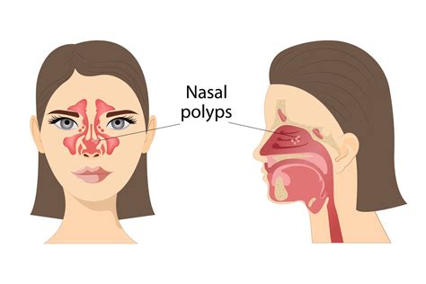 Medical Vector Illustration Of Nasal Polyps Non Cancerous Neoplasms On