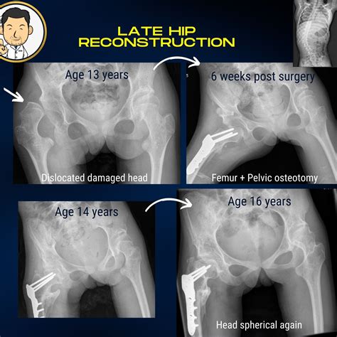 Cerebral Palsy Hip Reconstruction