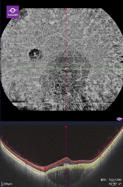 Choroidal Osteoma With Secondary Cnv Captured With Full Range Ss Octa Towardpi