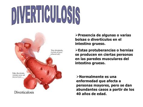 Foto De Enfermedades Del Sistema Digestivo