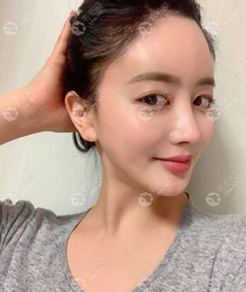 找韩国moplus植发医院文珉善院长种植发际线花的这3万真值 韩国moplus毛加毛发移植医院发际线案例 毛毛网