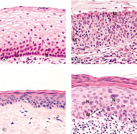 Dysplasia And Neoplasia Clinical Tree