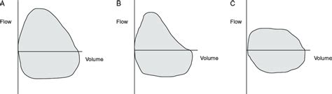 Demonstration Of Various Flow Volume Loops A Normal Flow Volume Download Scientific Diagram