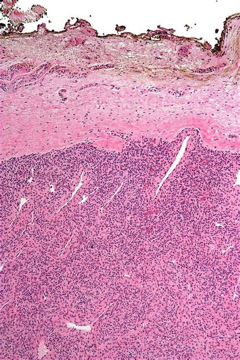 Resection Margin Alchetron The Free Social Encyclopedia