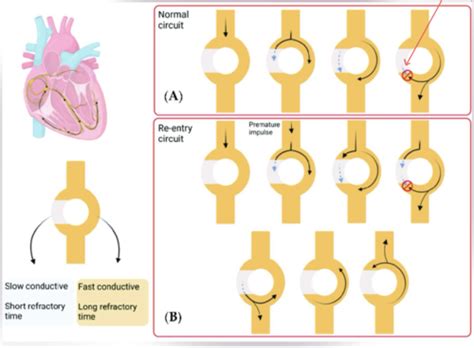 Afib Atrial Fibrillation Flashcards Quizlet