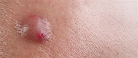 Furunculus Imagens Procure 26 Fotos Vetores E Vídeos Adobe Stock