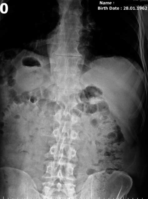 Acute Paralytic Ileus Induced By Quetiapine A Case Report European Psychiatry Cambridge Core