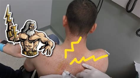 Scapulothoracic Bursitis Cortisone Injection At Steve Gallegos Blog