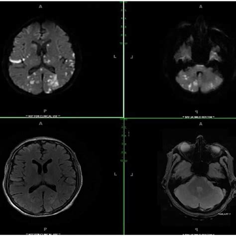 Diffusion Weighted Sequence Mri Reveals Innumerable Diffusion Defects