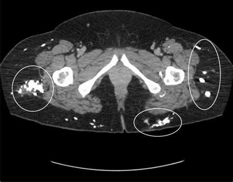 Southwest Journal Of Pulmonary Critical Care And Sleep Imaging Medical Image Of The Week