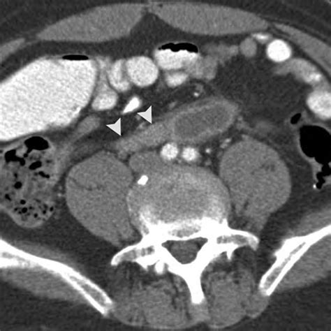 Pdf Goblet Cell Carcinoid Presenting As Appendicitis 15 Years After A Normal Ct Scan