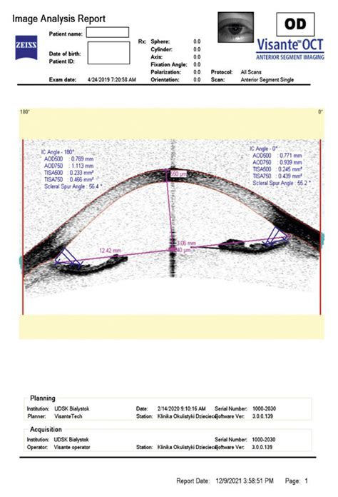 Concave Configuration Of The Iris Before Lpi Download Scientific Diagram