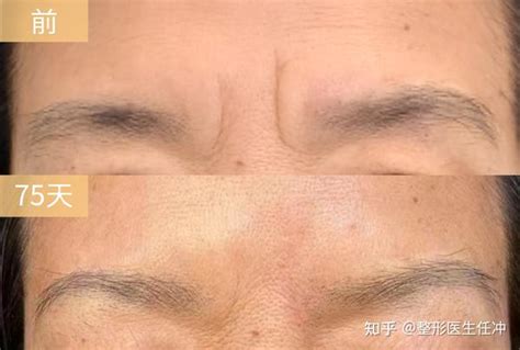 眉间凹陷的重度川字纹切除手术全过程指南：从术前到术后，你想知道的都在这里 知乎