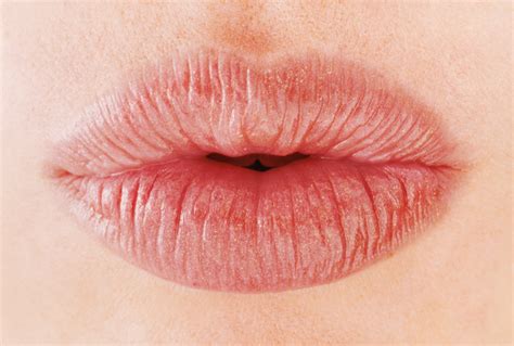 Why Do I Have Dry Lips In Summer