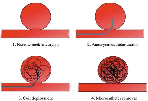 Coil Embolization Material At Linda Lara Blog