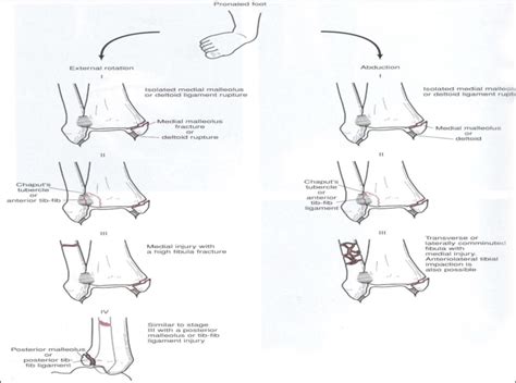 Ankle Hansen Lauge Classification Fractures Injuries Reduction Figure