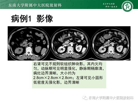 肾嫌色细胞癌影像诊断 全网 解剖图 患者