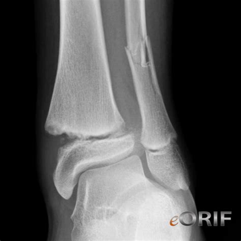 Cpt Code For Distal Fibula Fracture Orif At Crystal Yazzie Blog