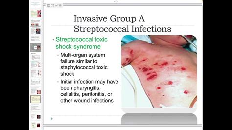 Streptococcus Part 2 Youtube