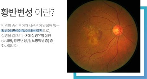 김포 한길안과 황반변성