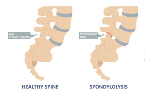 Spondylolysis Definition Spine Info