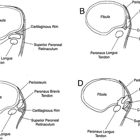 Pdf Peroneal Groove Deepening As The Treatment Of Peroneal Tendon