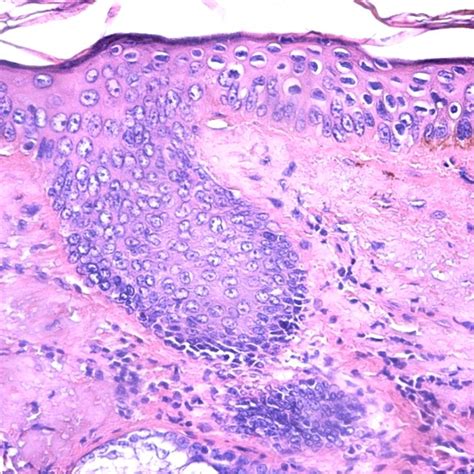 Adenoid Basal Cell Carcinoma With A Moderate Reaction To Pan Ck Download Scientific Diagram