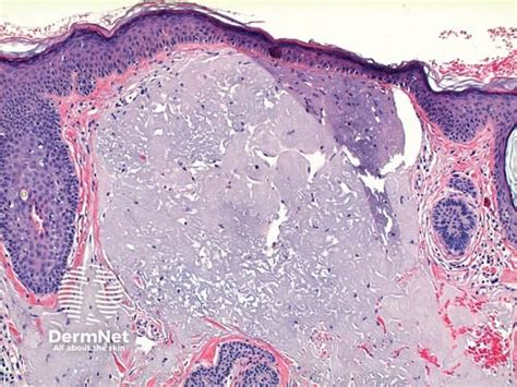 Favre Racouchot Syndrome Pathology