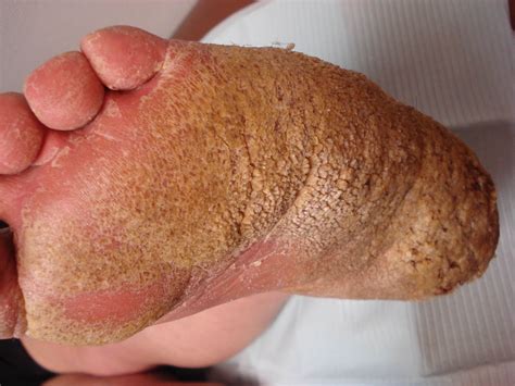 Virtual Grand Rounds In Dermatology 2 0 Hidrotic Ectodermal Dysplasia