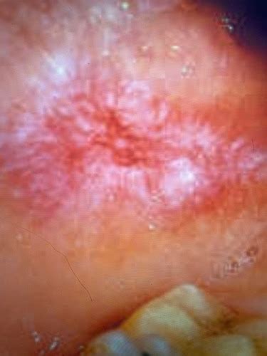 Practicum 2 Lesion Description Flashcards Quizlet