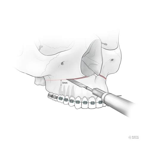 Maxillary Osteotomy Medical Illustrations — Biotic Artlab