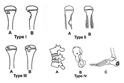 Roberts Classification Modified Classification Of Subacute