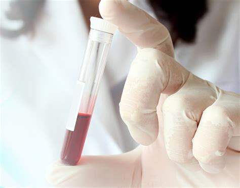 Platelet Aggregation Test 708x556 2x
