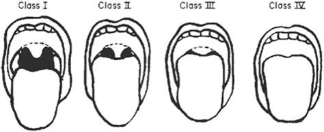 Obstructive Sleep Apnoea Tnz