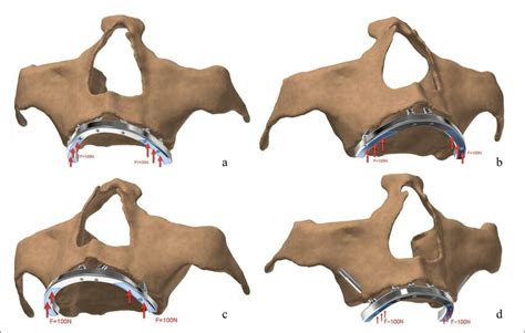 Occlusal Loading Force At Charles Dunaway Blog