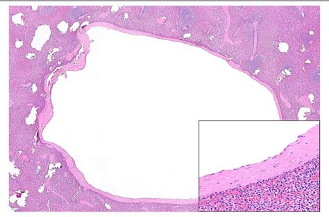 Figure 2 From Differential Diagnosis Of Cystic Lesions Of The Spleen A