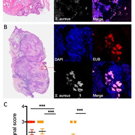 S Aureus Is Associated With Hyperkeratotic Areas In Ak And Scc And