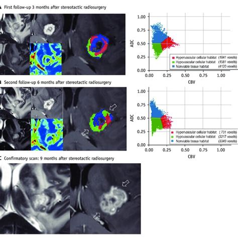 Longitudinal Mri Tumor Habitat Analysis And Associations With Download Scientific Diagram
