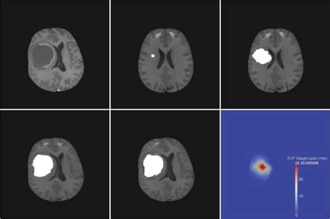 Atlas Based Segmentation Of Tumor Bearing Brain Images Neupsy Key