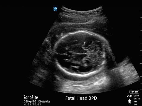 Fetal Head Bpd Fujifilm Sonosite