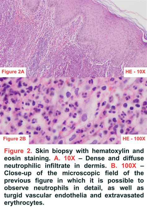 Pathergy Phenomenom Indicator Of Recurrent Vegetative Pyoderma Gangrenosum